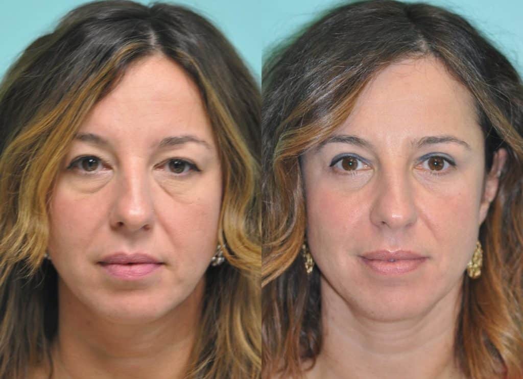 CO2 Laser Resurfacing | Erbium laser Washington DC and Virginia