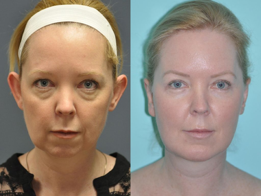 Otoplasty | Virginia, Washington D.C. and Maryland