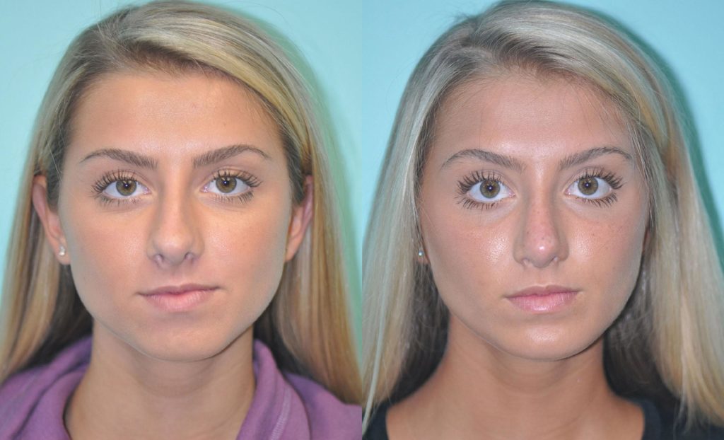 Chin Augmentation Virginia | Chin Implant Washington D.C. and Maryland