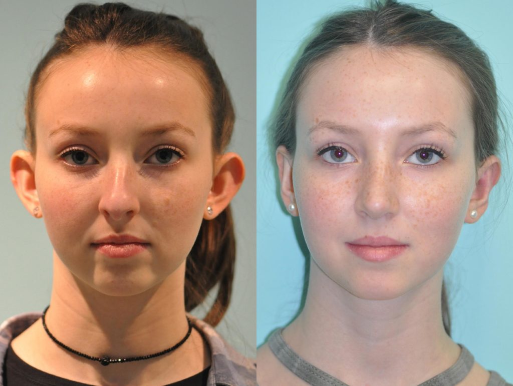 Otoplasty | Virginia, Washington D.C. and Maryland