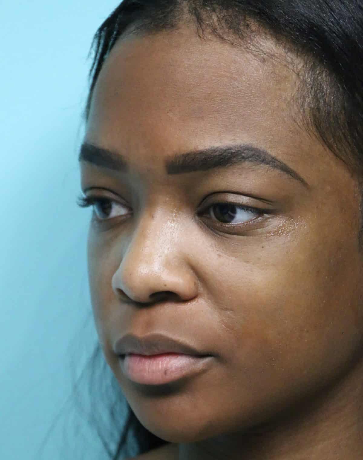 Cheek Filler | Cheek Injections - Virginia - Washington D.C. - Maryland