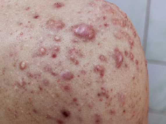 Acne Scar Reduction Virginia, Washington D.C. & Maryland