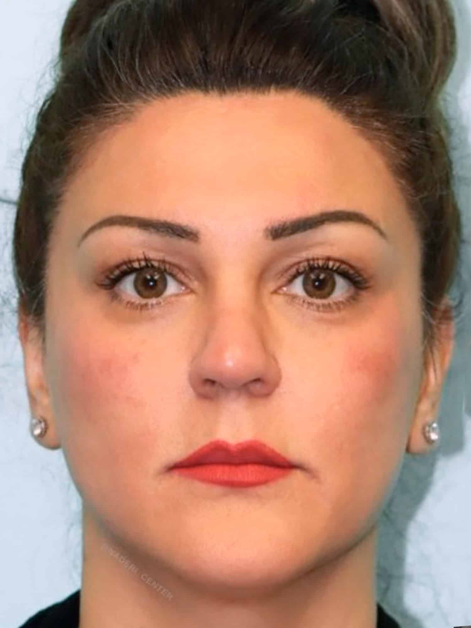 Cheek Filler | Cheek Injections - Virginia - Washington D.C. - Maryland