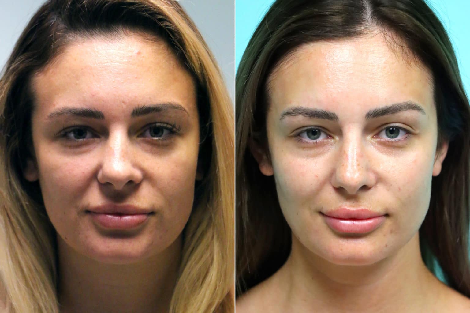 Injections, Non-Surgical Rhinoplasty photos | Chevy Chase, MD | Patient ... Injections, Non-Surgical Rhinoplasty photos | Chevy Chase, MD | Patient ...