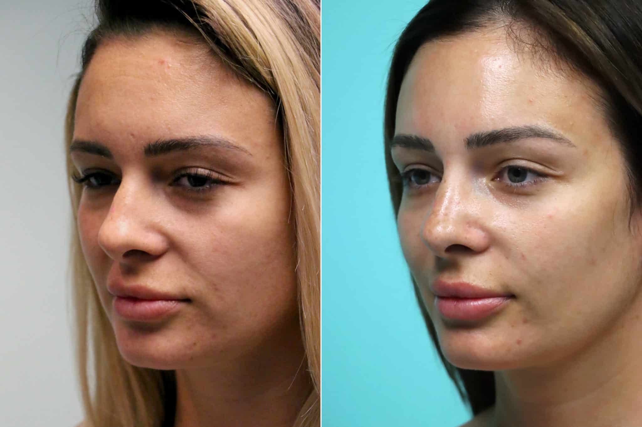Injections, Non-Surgical Rhinoplasty photos | Chevy Chase, MD | Patient ... Injections, Non-Surgical Rhinoplasty photos | Chevy Chase, MD | Patient ...