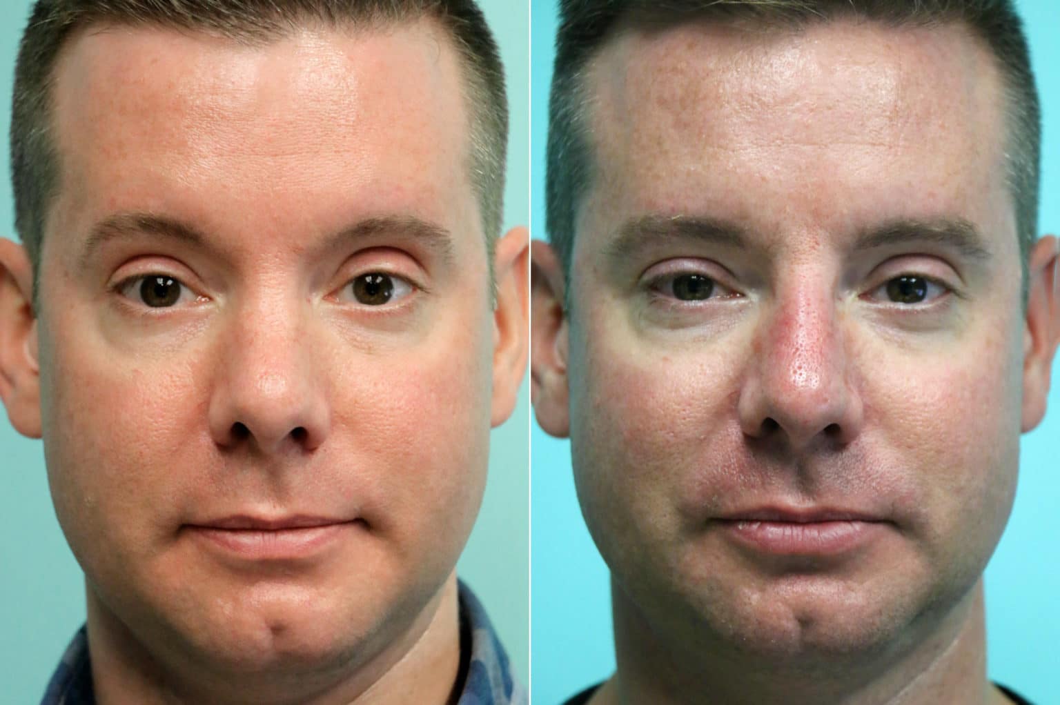Non Surgical Rhinoplasty Photos Chevy Chase Md Patient 18613