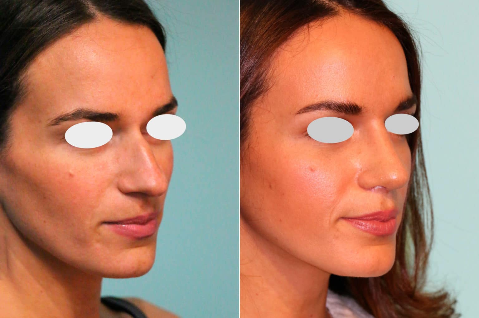 Non Surgical Rhinoplasty Photos Chevy Chase Md Patient 18873