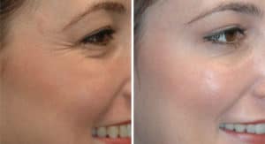 Dysport Injection - Reston, Virginia- Chevy Chase, Maryland