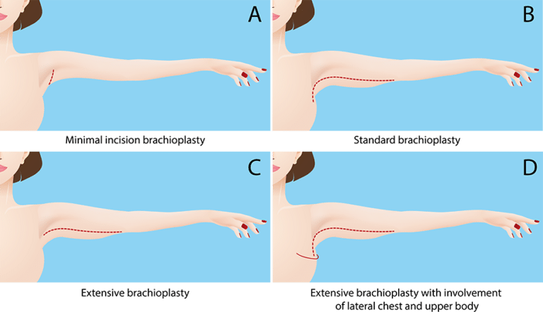 Brachioplasty in Virginia, Washington D.C. & Maryland
