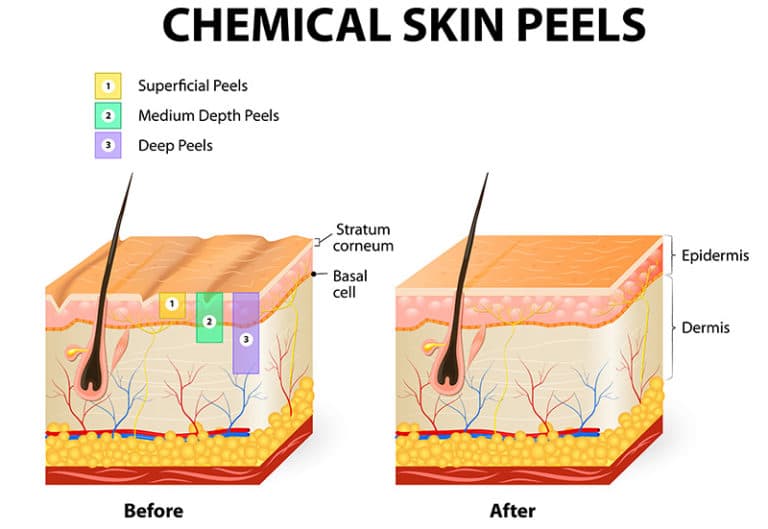 Chemical Peels in Virginia, Washington D.C. & Maryland