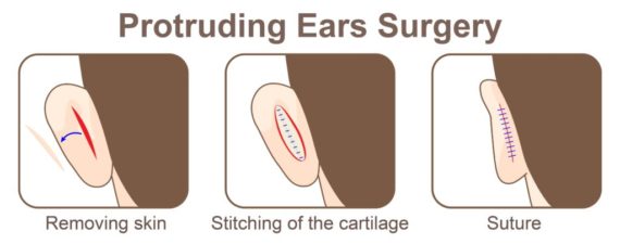 Otoplasty Surgery in Virginia, Washington D.C. & Maryland