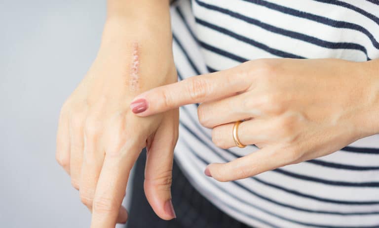 Scar Revision Surgery Virginia, Washington D.C. & Maryland