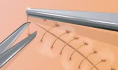 Scar Revision Surgery Virginia, Washington D.C. & Maryland