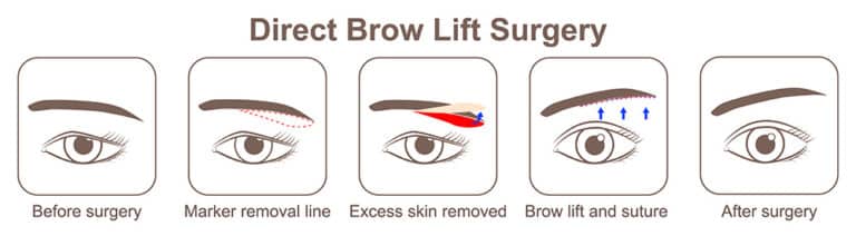 Should you get a Brow Lift or a Blepharoplasty?