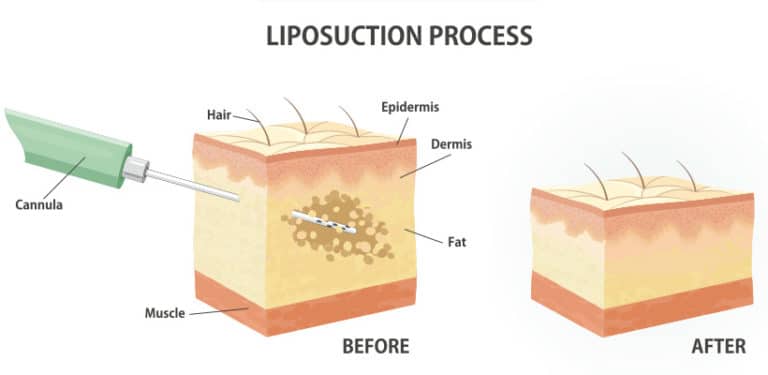 Submental Liposuction Virginia, Washington D.C. & Maryland