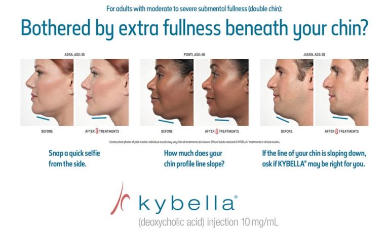 Kybella | Double chin - Fairfax - Virginia - Washington D.C. - Maryland