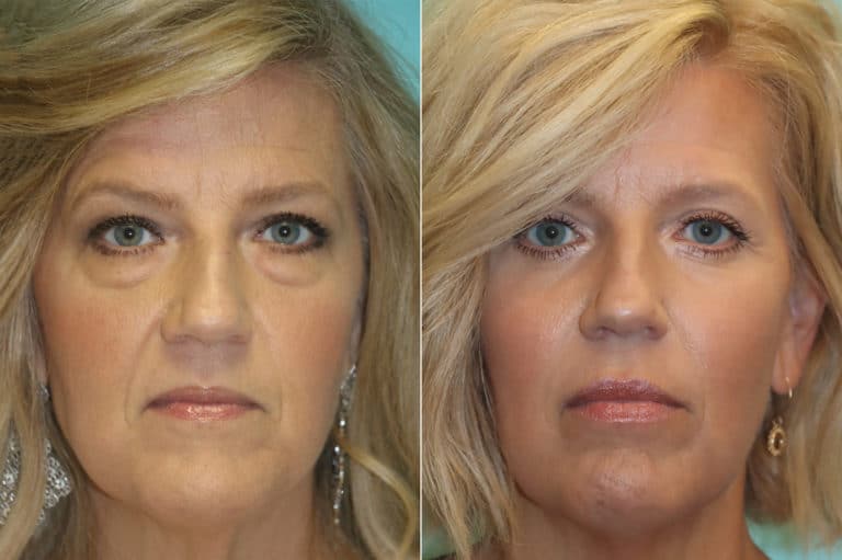 Blepharoplasty, Brow Lift photos | Chevy Chase, MD | Patient 22162 Blepharoplasty, Brow Lift photos | Chevy Chase, MD | Patient 22162