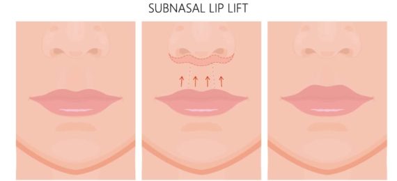 Lip Enhancement | Virginia, Washington D.C. and Maryland