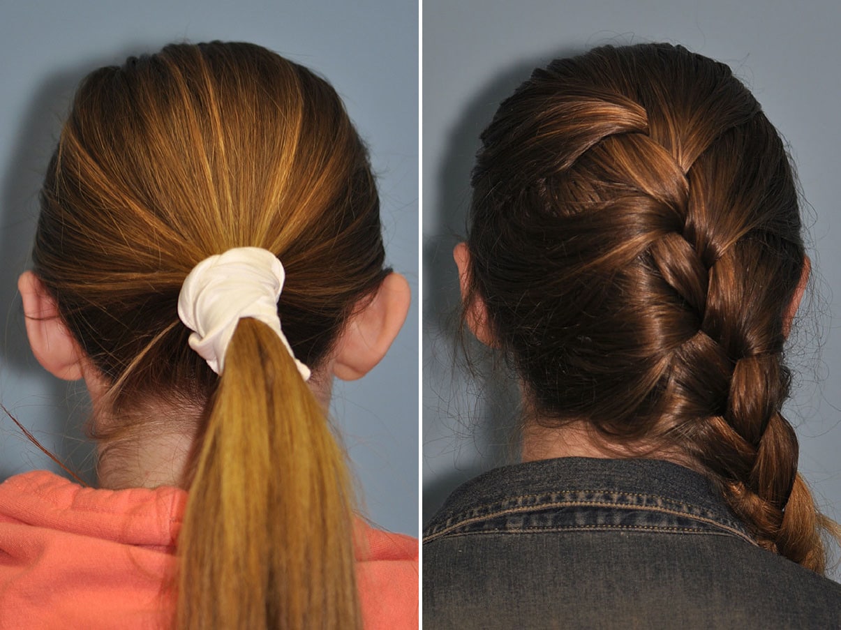 Otoplasty | Virginia, Washington D.C. and Maryland