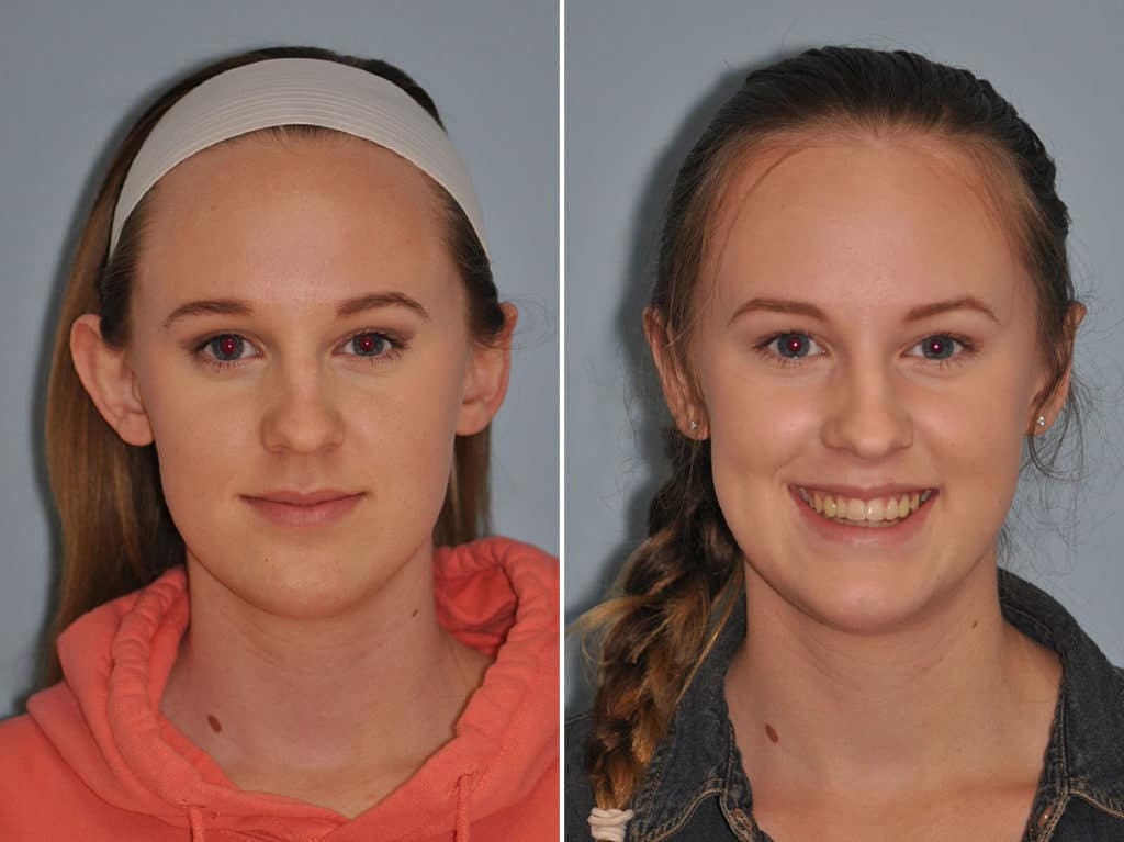 Otoplasty | Virginia, Washington D.C. and Maryland