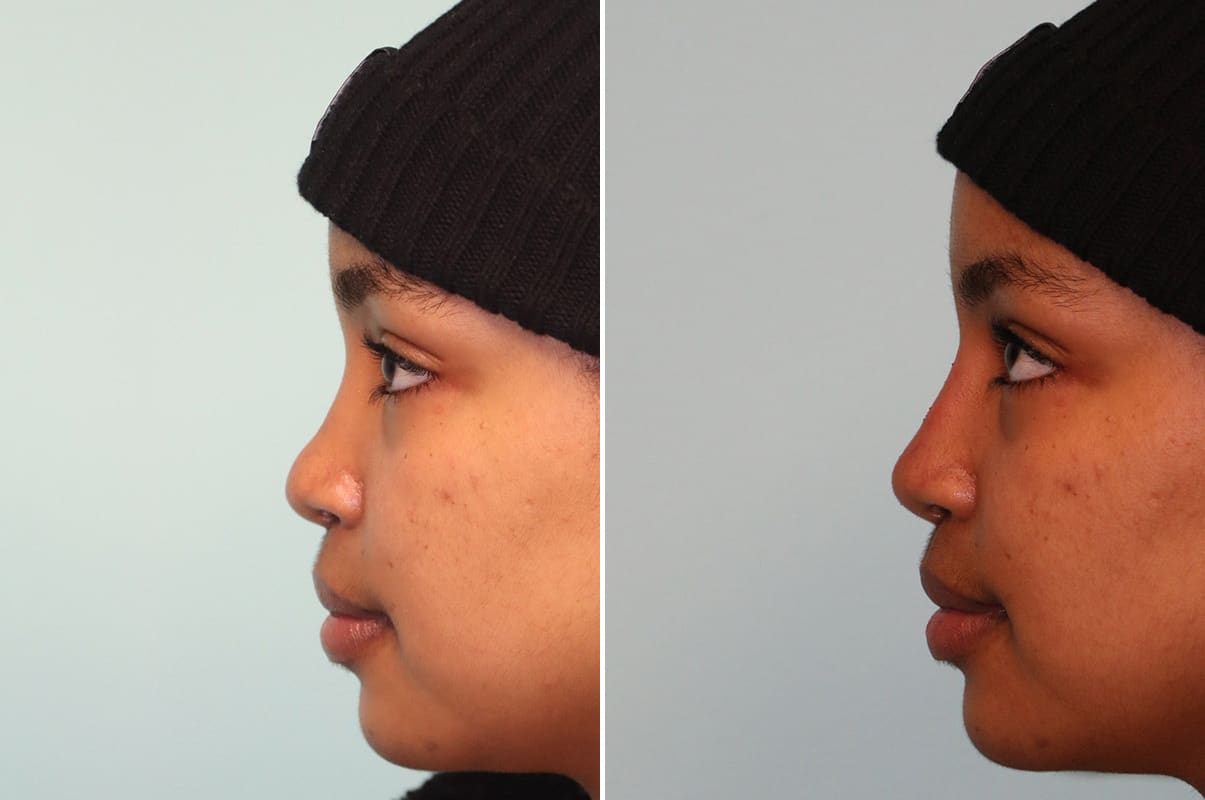 Non Surgical Rhinoplasty Photos Chevy Chase Md Patient 25069