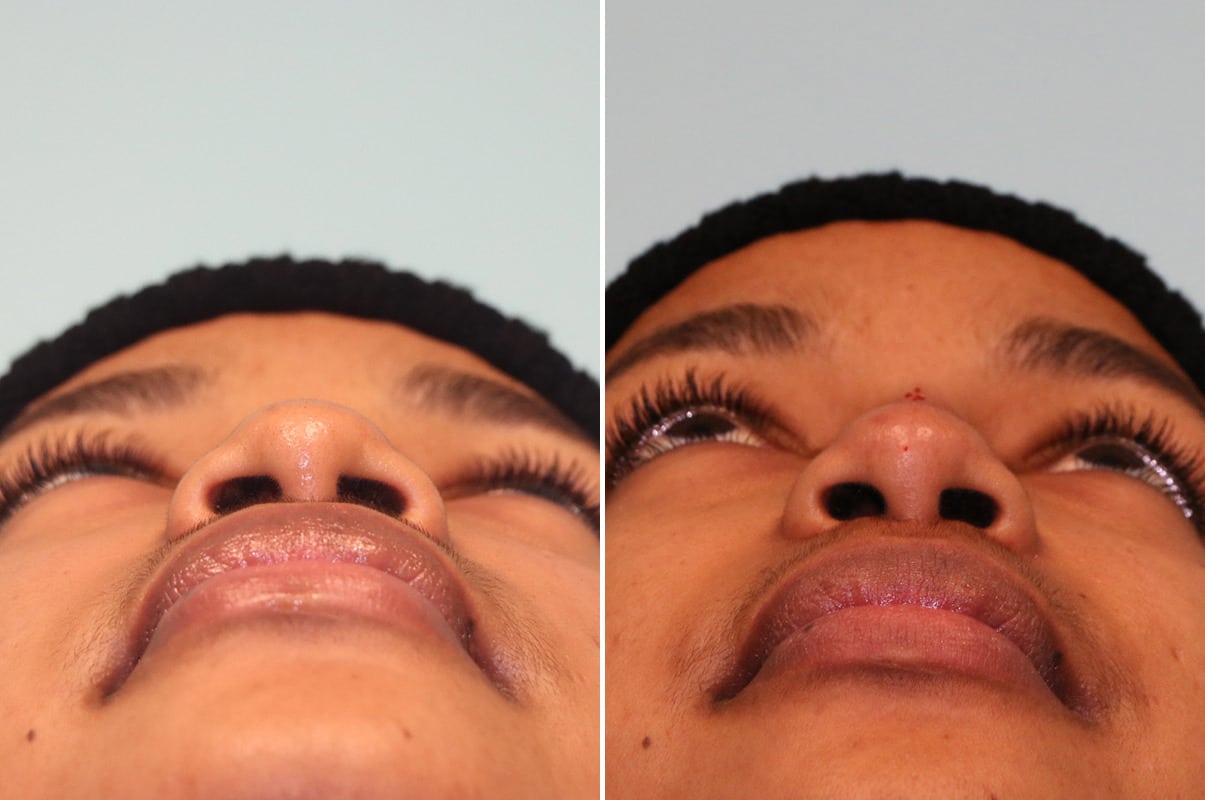 Non Surgical Rhinoplasty Photos Chevy Chase Md Patient 25069
