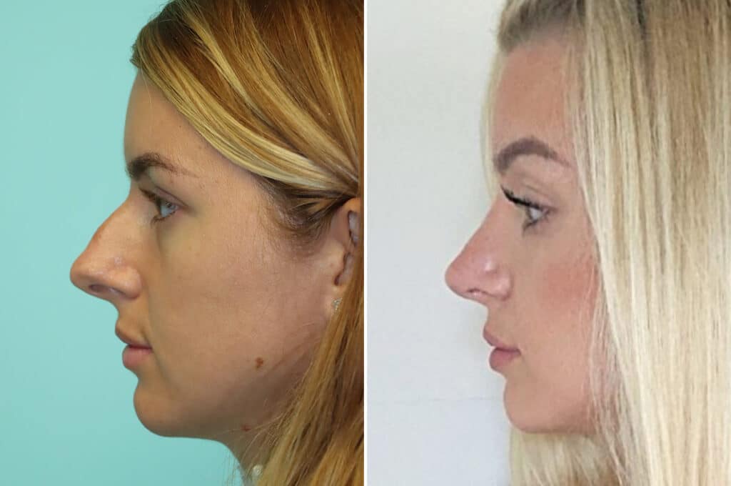 Rhinoplasty Photos Chevy Chase Md Patient 25237