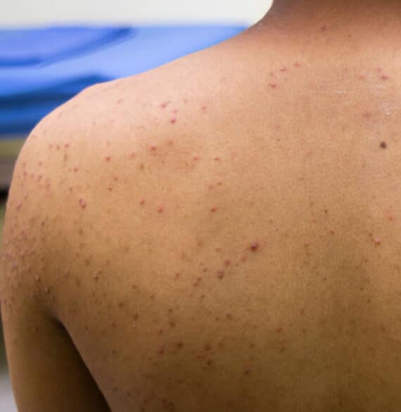Acne Treatments in Virginia, Washington D.C. & Maryland
