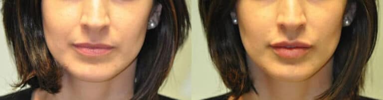 Lip Augmentation in Virginia, Washington D.C. & Maryland