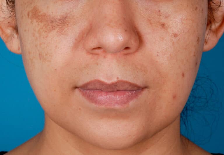 Hyperpigmentation Treatment in Virginia & Maryland