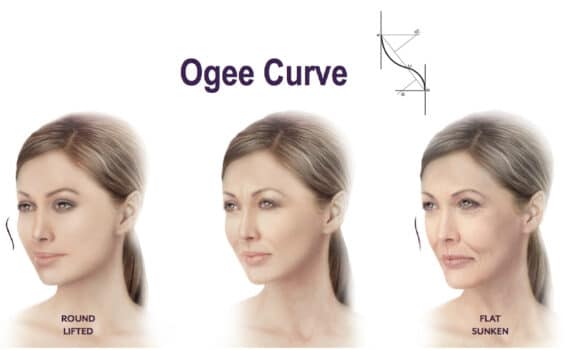 Cheek Fillers in Virginia, Washington D.C. & Maryland