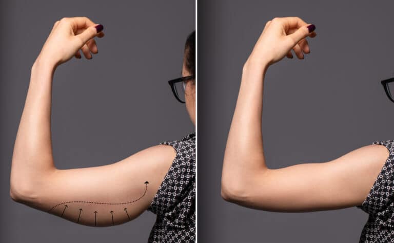 Brachioplasty Scars: Healing and Minimizing Appearance
