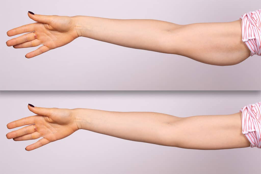 Differences and Considerations: Arm Liposuction vs Brachioplasty