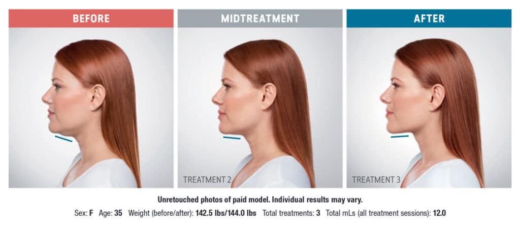 Kybella Injections in Virginia, Washington D.C. & Maryland