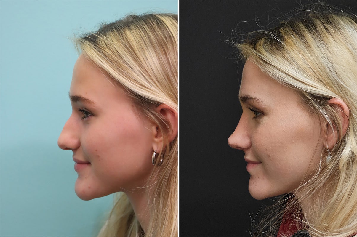 Anglo-Caucasian Rhinoplasty at The Naderi Center