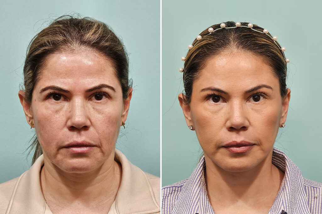 The Mar-a-Lago Face: America’s New Luxury Aesthetic