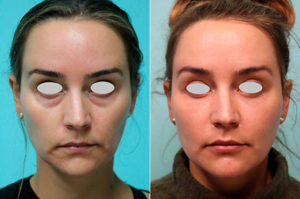 Facial Asymmetry Correction at The Naderi Center