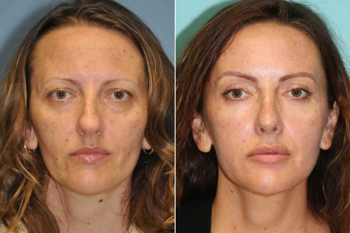 Undetectable Beauty Trend: Subtle Facial Surgery in 2025